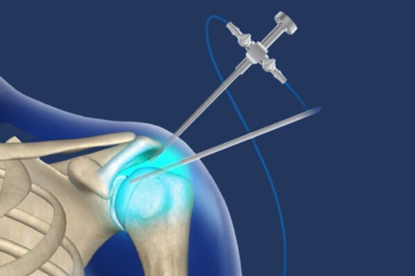 Shoulder Conditions and Procedures - Daniel G. Schwartz MD
